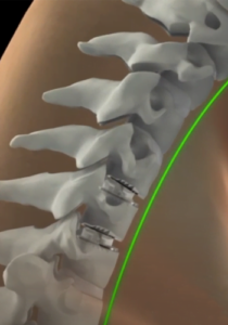 Artificial Disc Replacement Surgery | Dr Baker Neurosurgery
