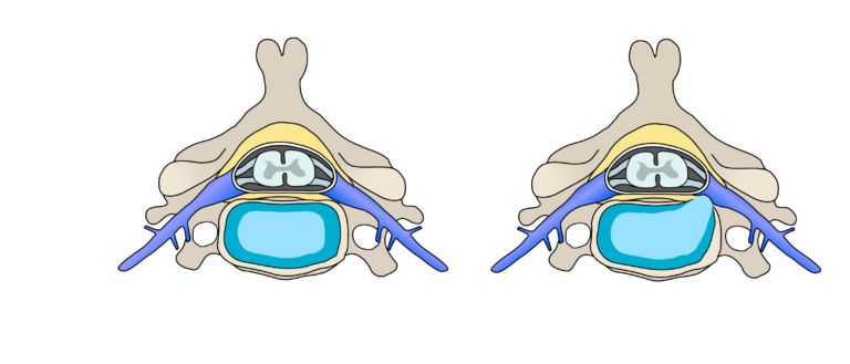 A Guide to Anterior Cervical Discectomy & Fusion or ACDF