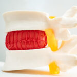 What is an Annular Bulge? | Dr Baker Neurosurgery Dallas