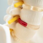 What is an Annular Bulge? | Dr Baker Neurosurgery Dallas