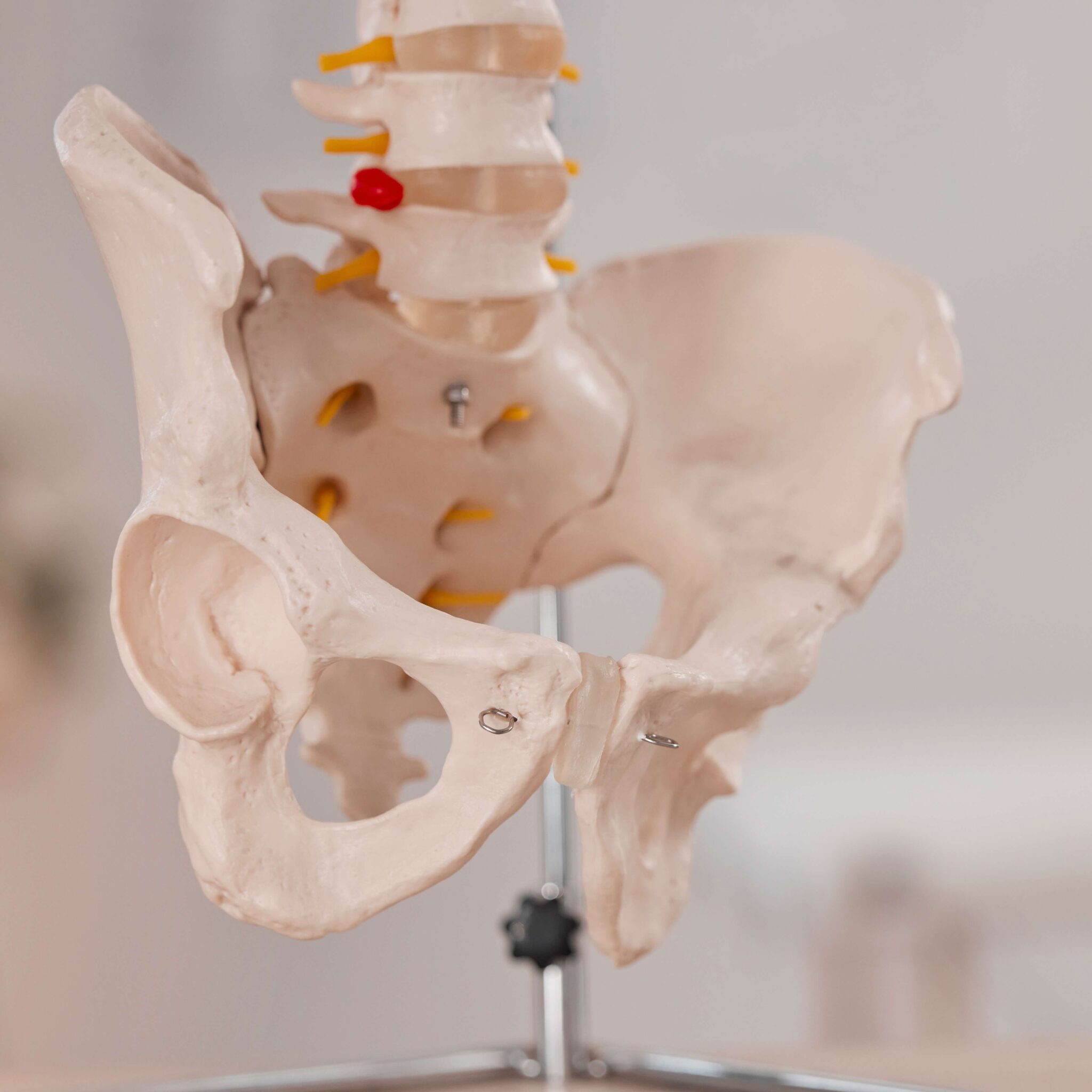 What is Stage 4 Sciatica? | Dr Baker Neurosurgery Blog